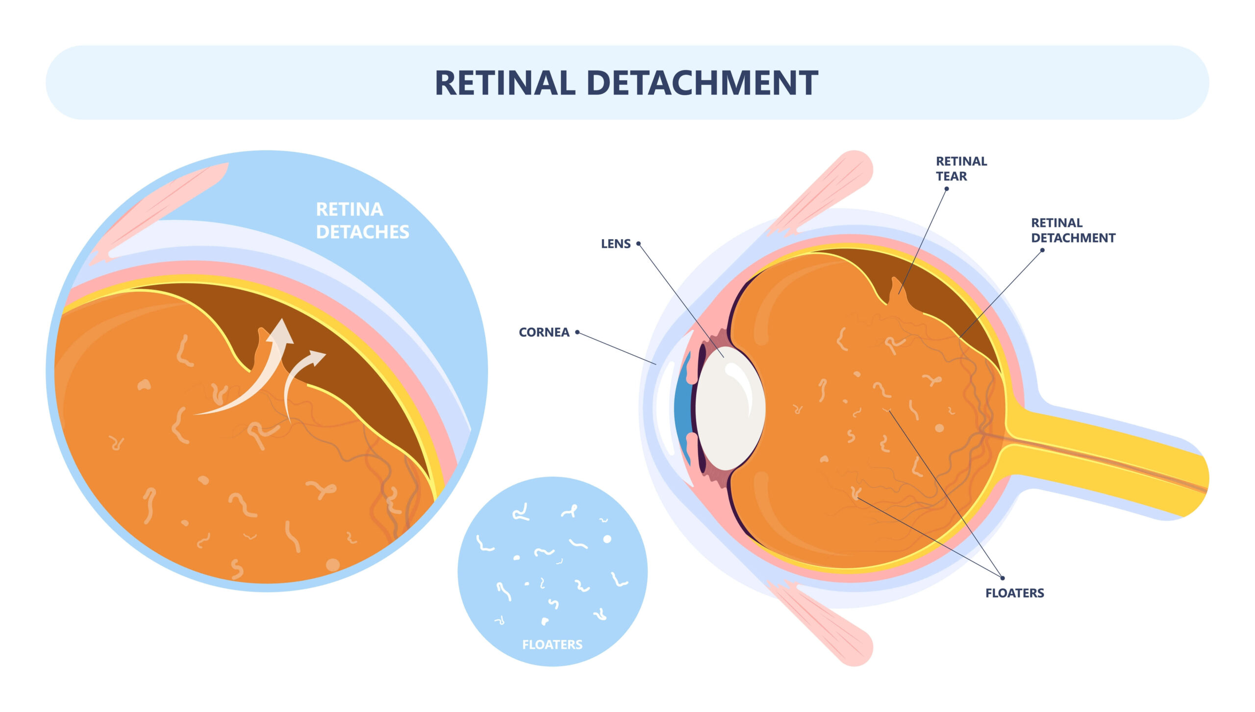 Signs of Retinal Detachment, Retinal Detachment Symptoms